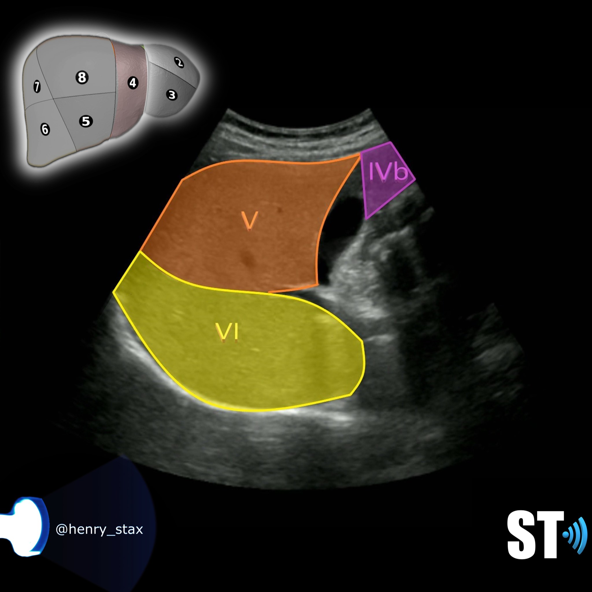 Couinaud’s Liver Segments – Sonographic Tendencies