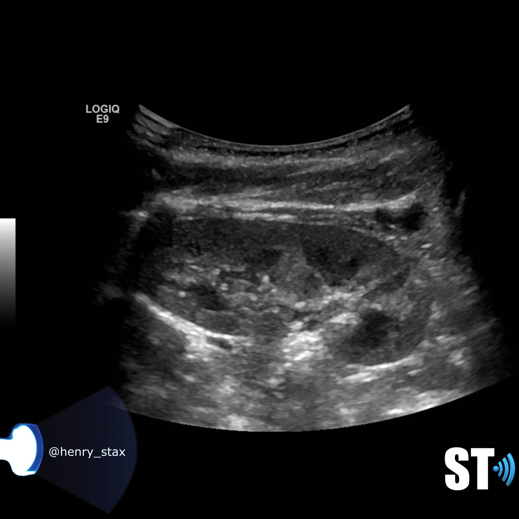 Renal Pathology – Sonographic Tendencies