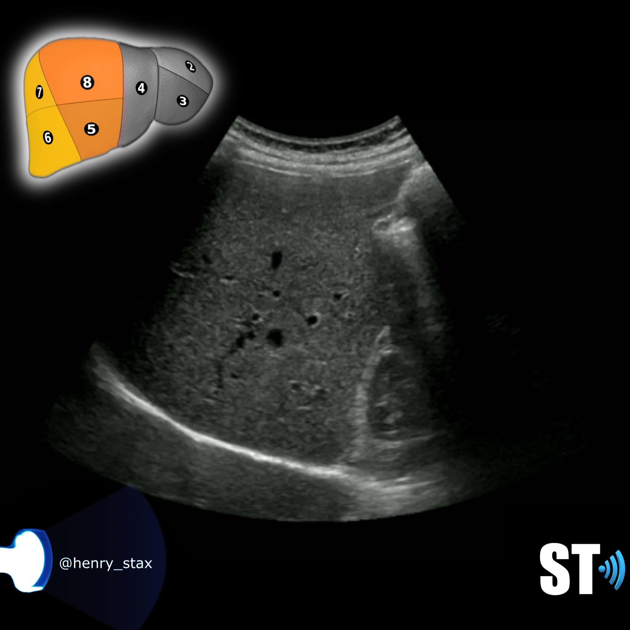 Couinaud’s Liver Segments – Sonographic Tendencies