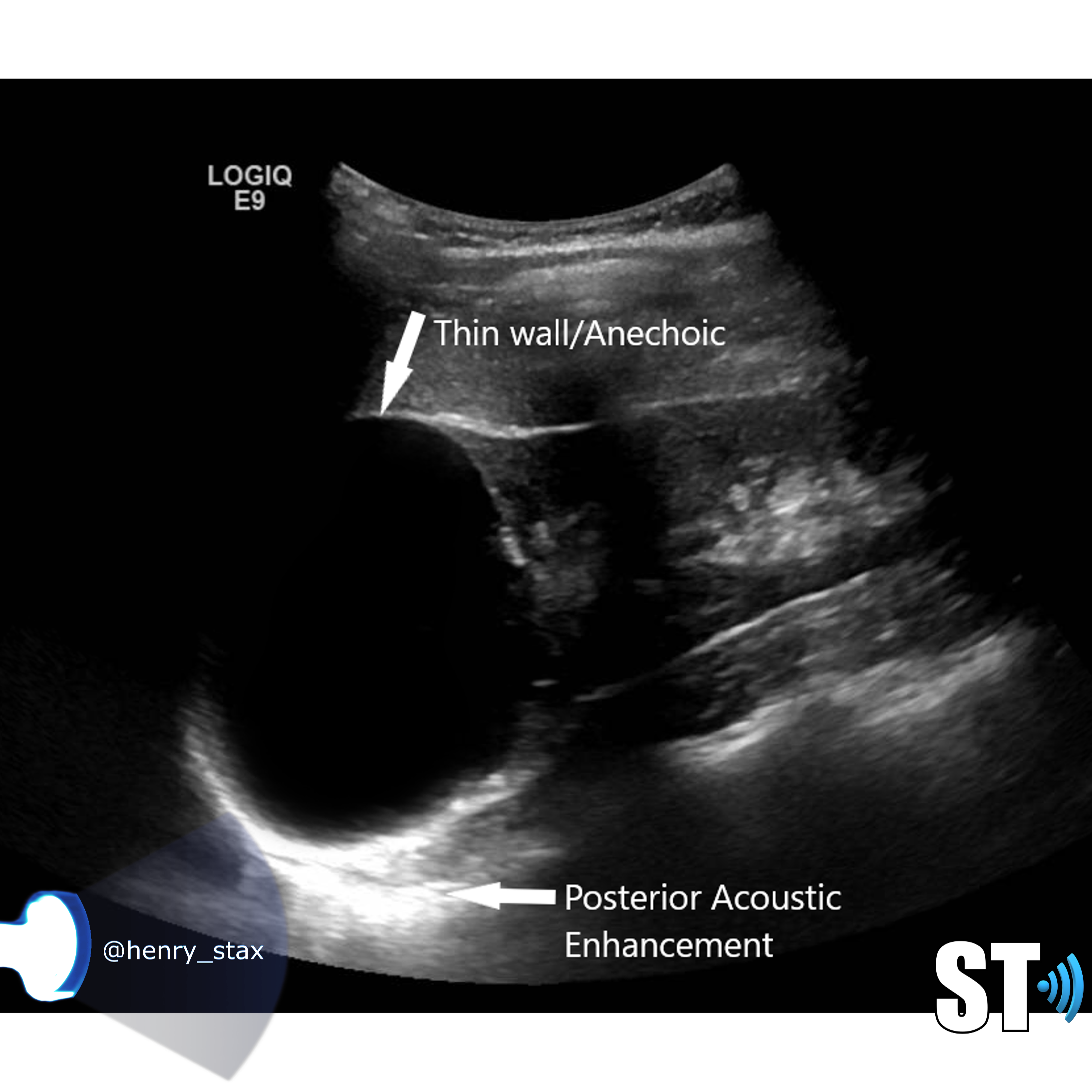 Renal Pathology – Sonographic Tendencies