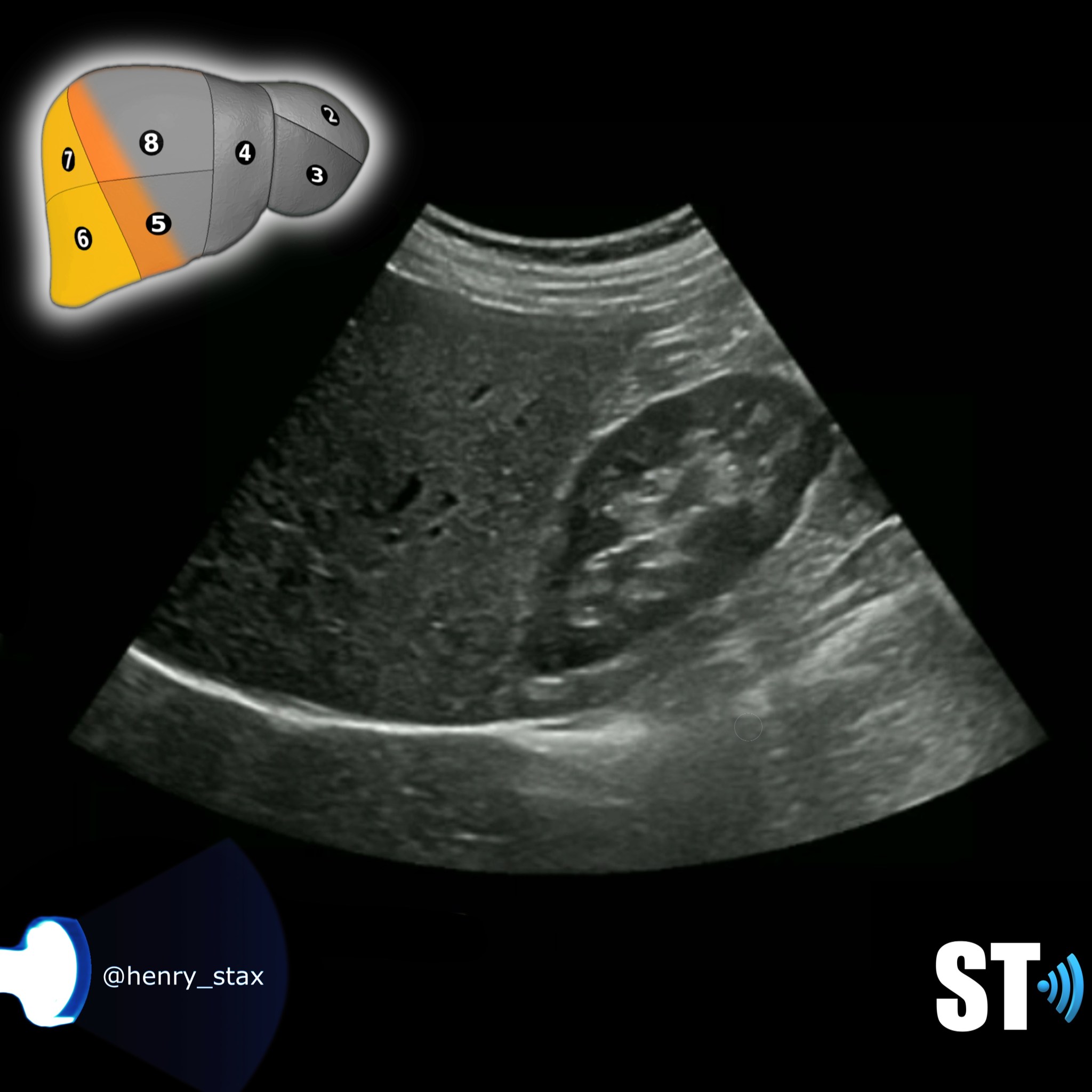 Couinaud’s Liver Segments – Sonographic Tendencies