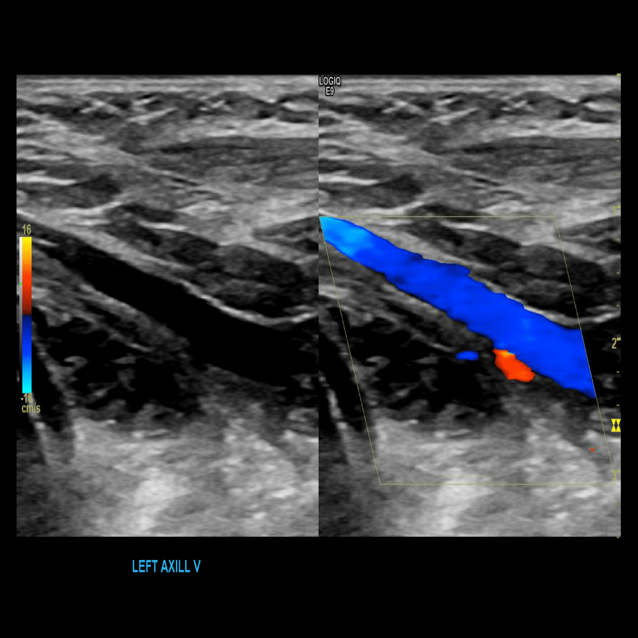 Upper Extremity Venous Doppler – Sonographic Tendencies