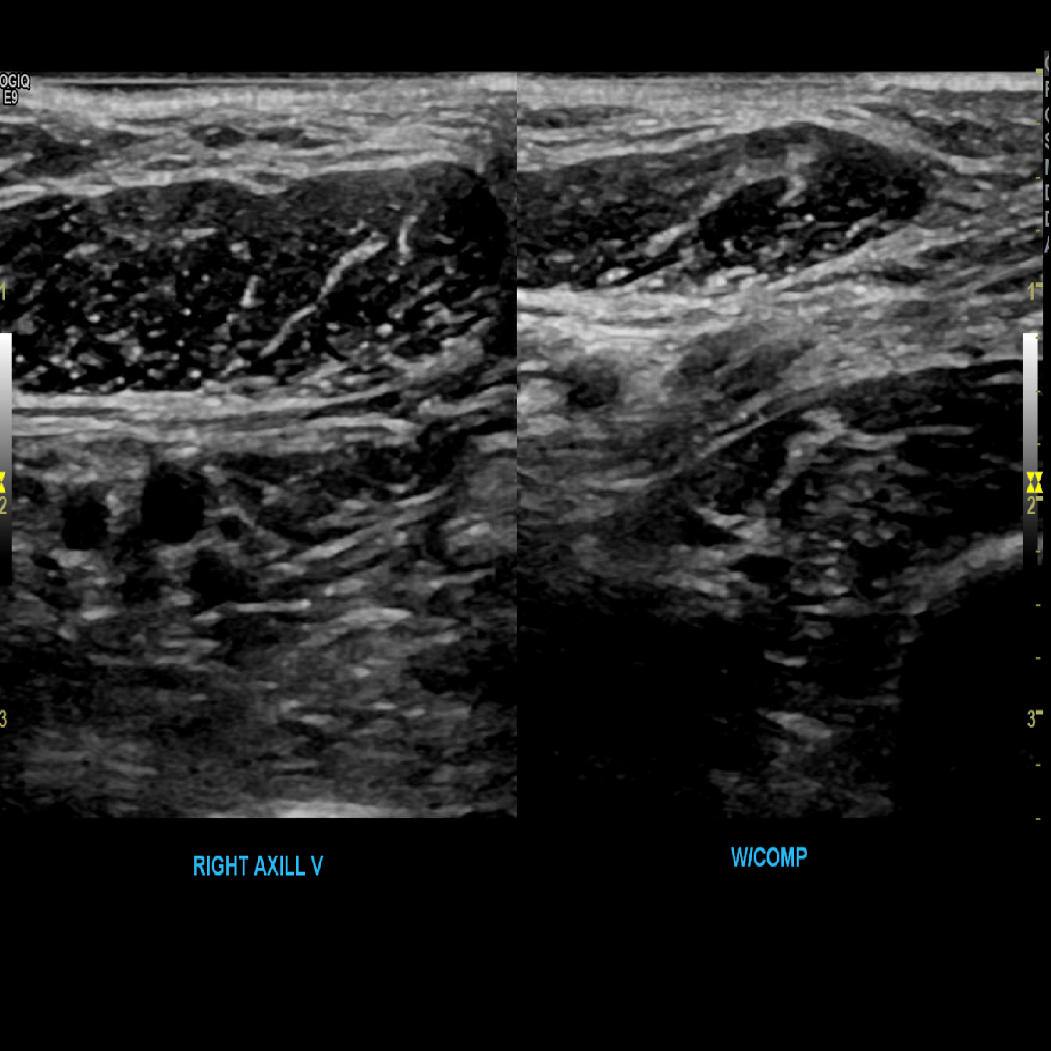 Upper Extremity Venous Doppler – Sonographic Tendencies