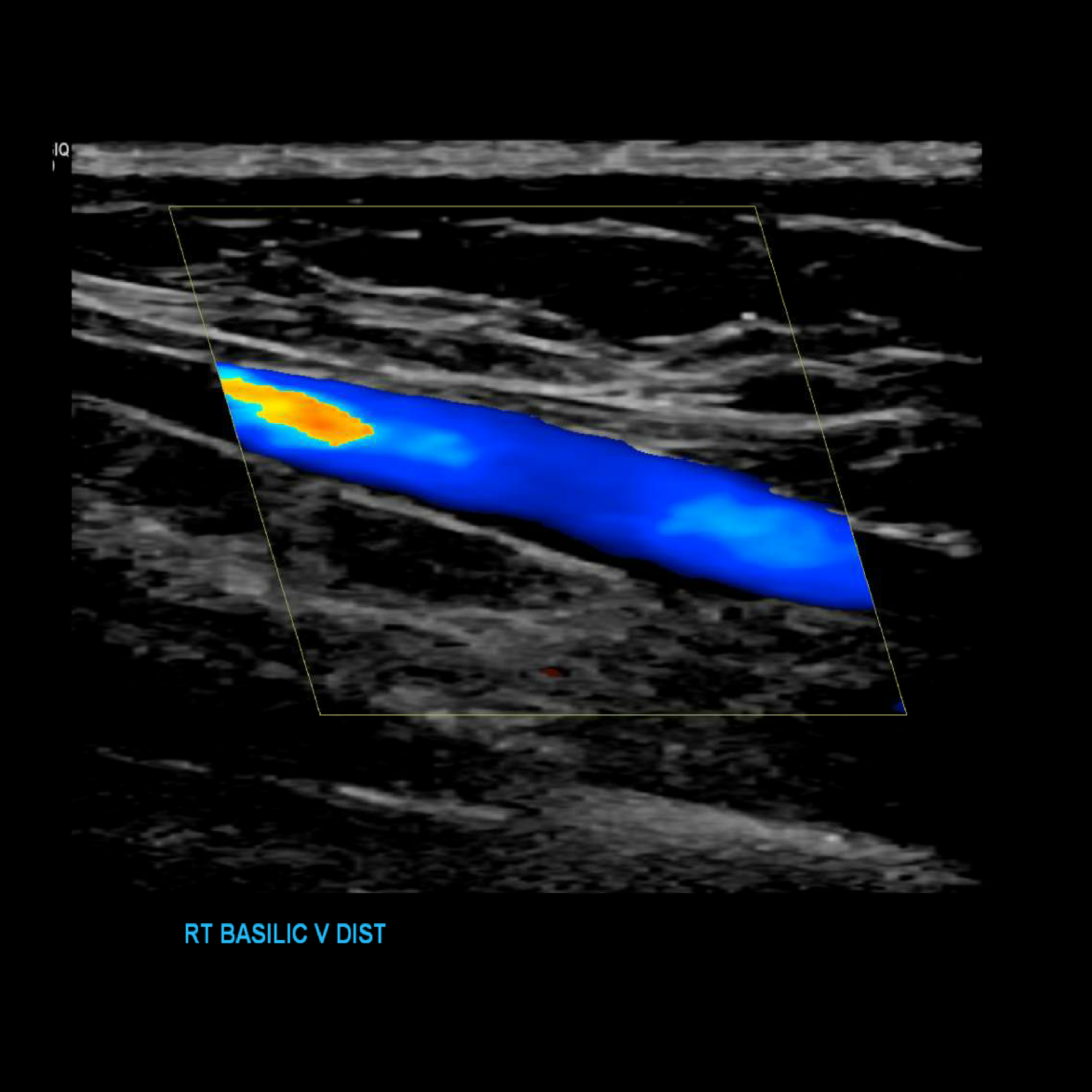 Upper Extremity Venous Doppler – Sonographic Tendencies