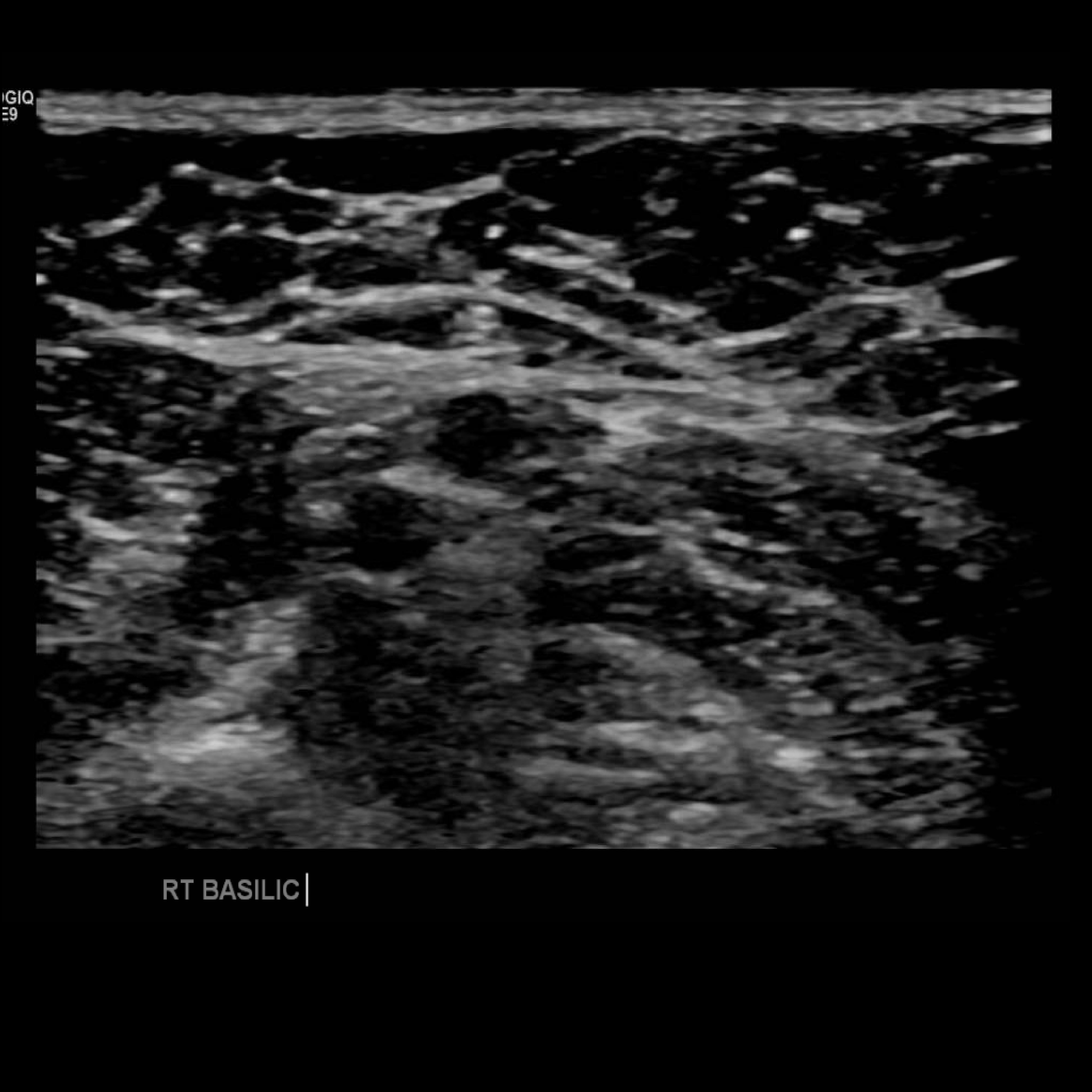Upper Extremity Venous Doppler – Sonographic Tendencies