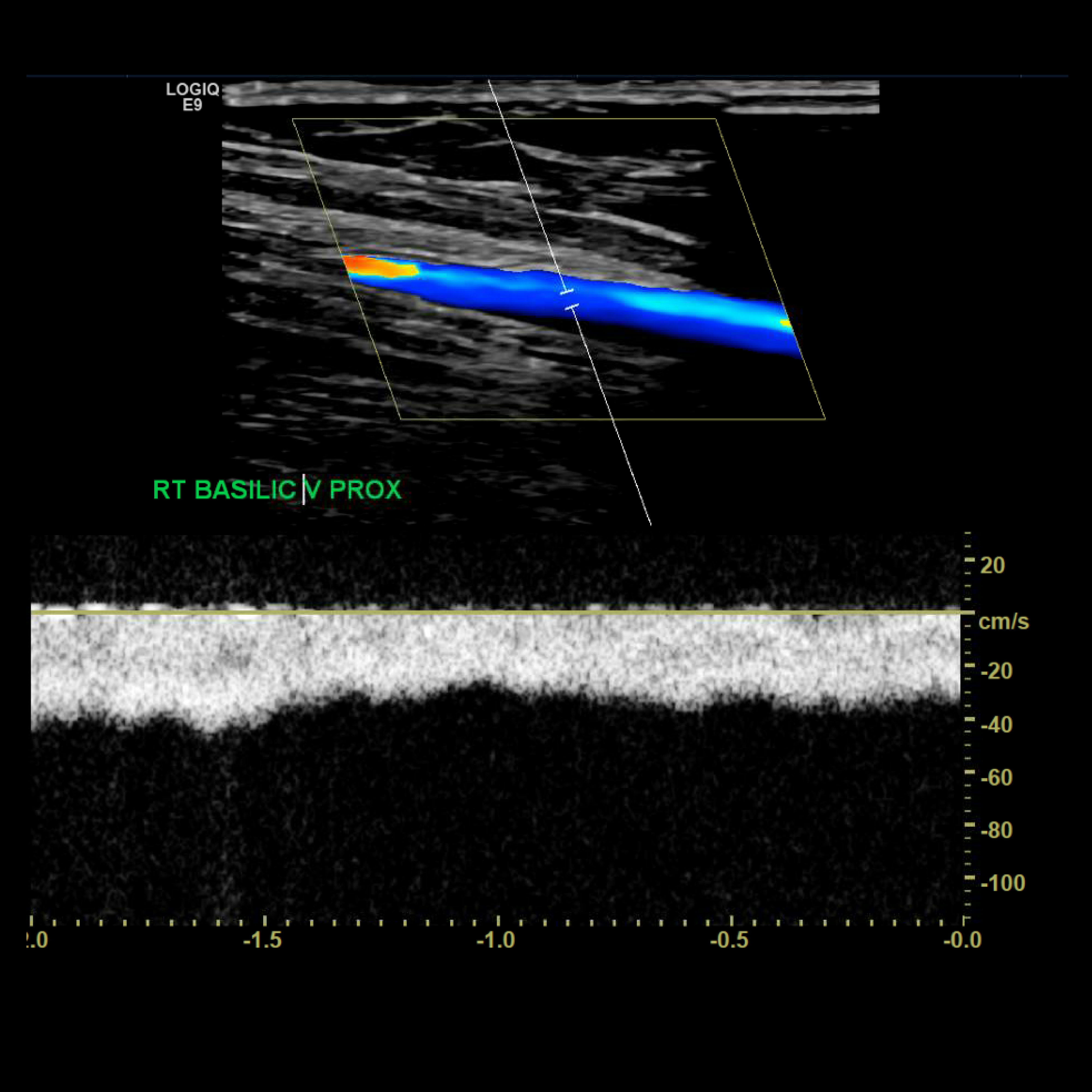 Upper Extremity Venous Doppler – Sonographic Tendencies