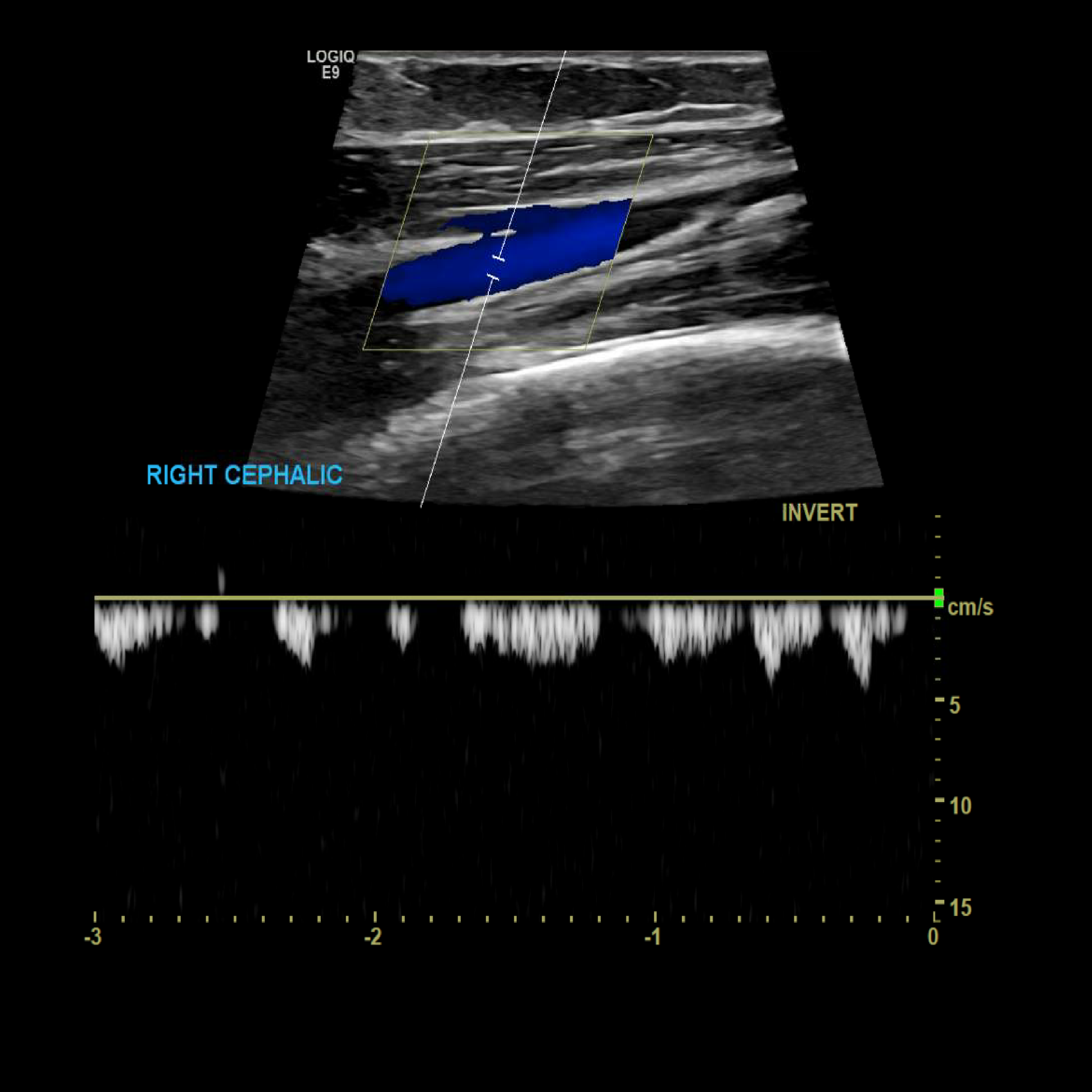 Upper Extremity Venous Doppler – Sonographic Tendencies