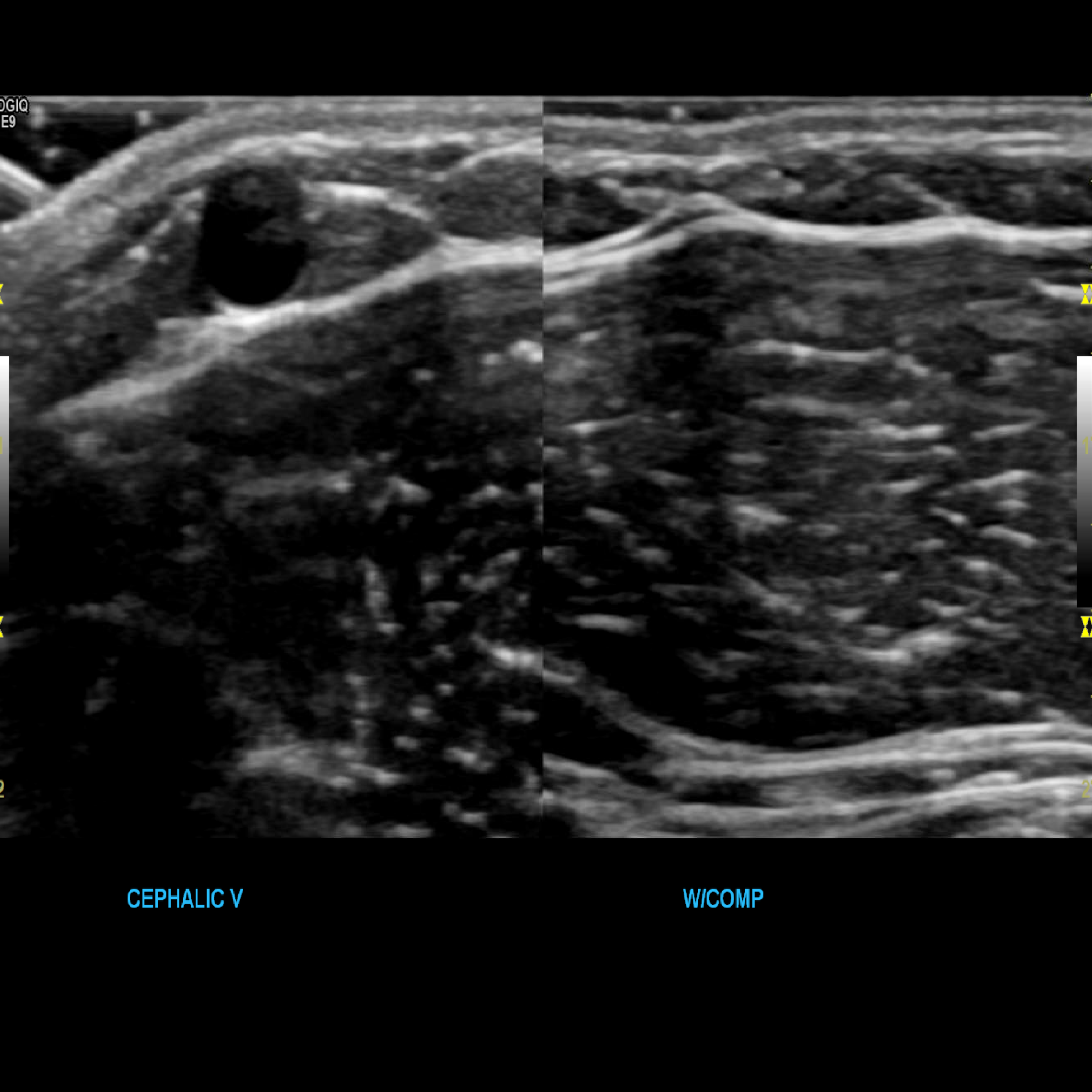 Upper Extremity Venous Doppler – Sonographic Tendencies