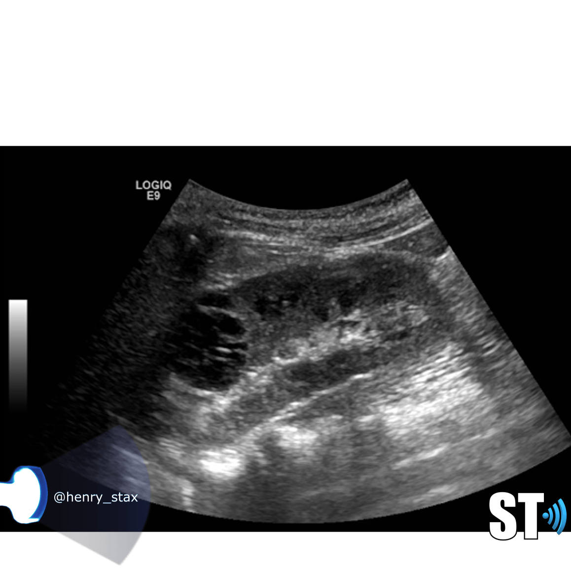 Renal Pathology – Sonographic Tendencies