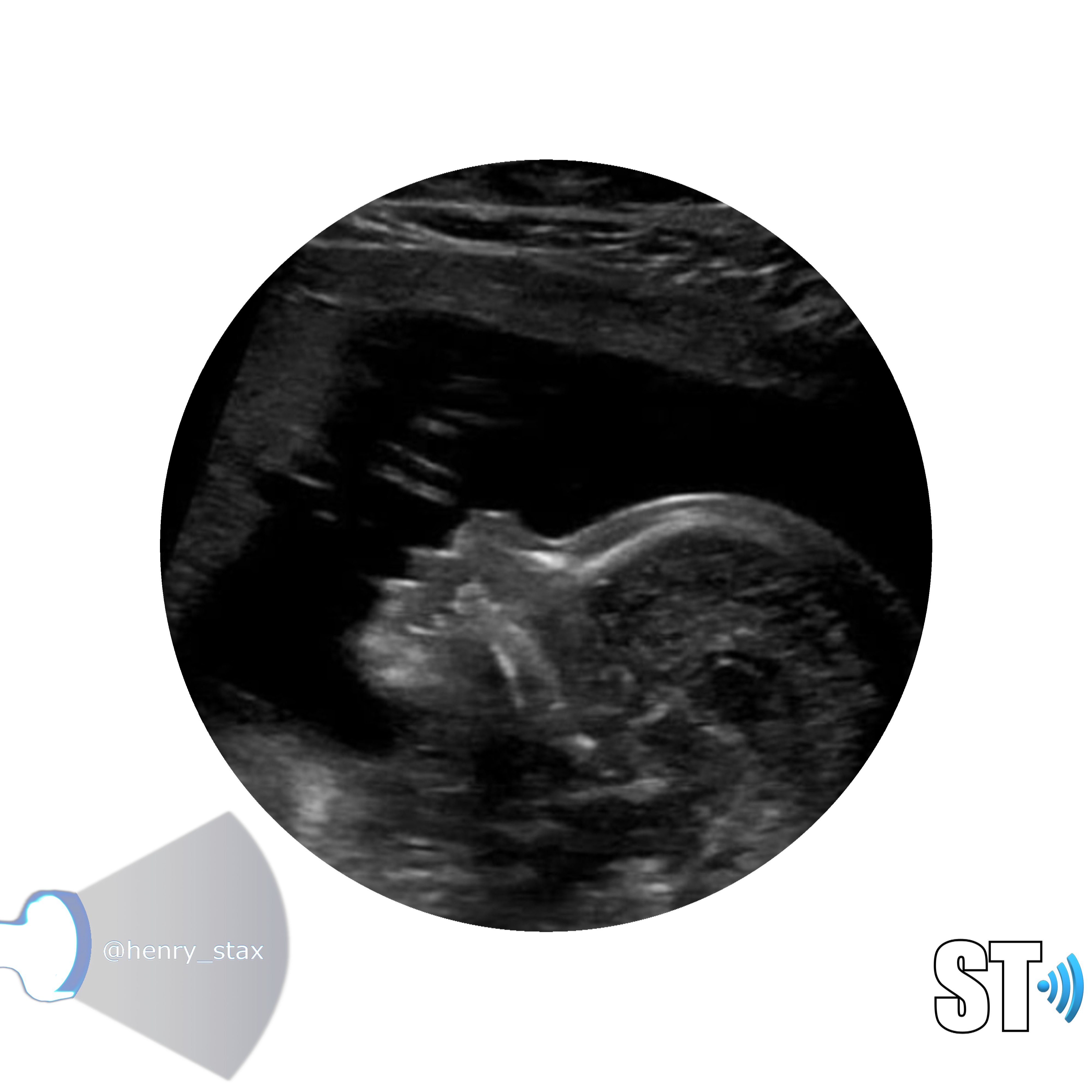OB Ultrasound Second Trimester (The Basics) – Sonographic Tendencies
