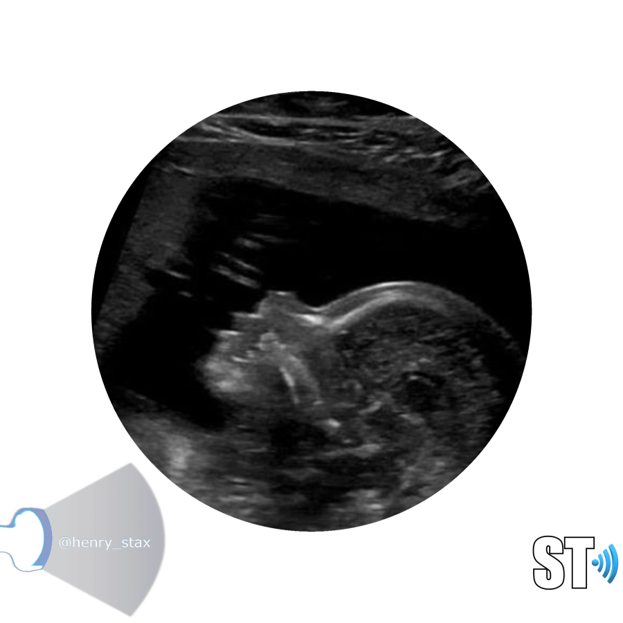 OB Ultrasound Second Trimester (The Basics) – Sonographic Tendencies