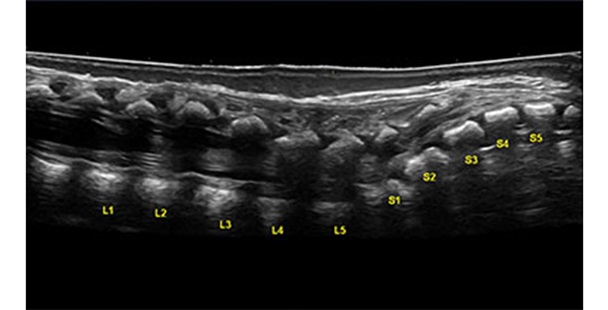 Neonatal/Infant Spine – Sonographic Tendencies