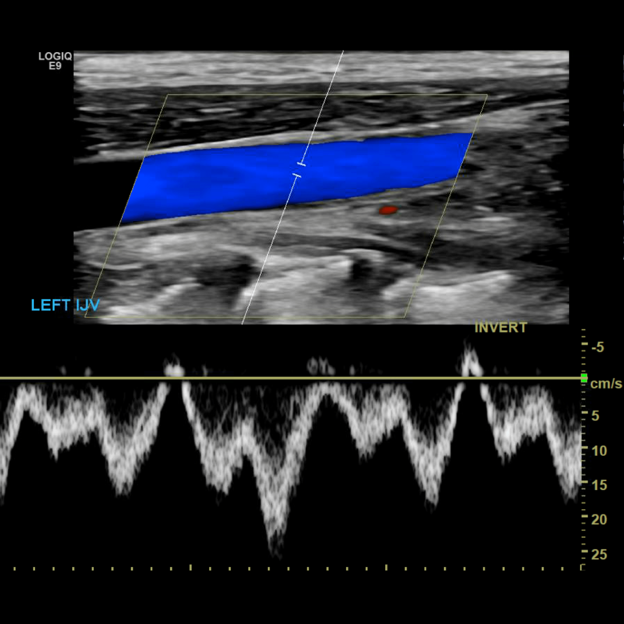 Upper Extremity Venous Doppler – Sonographic Tendencies