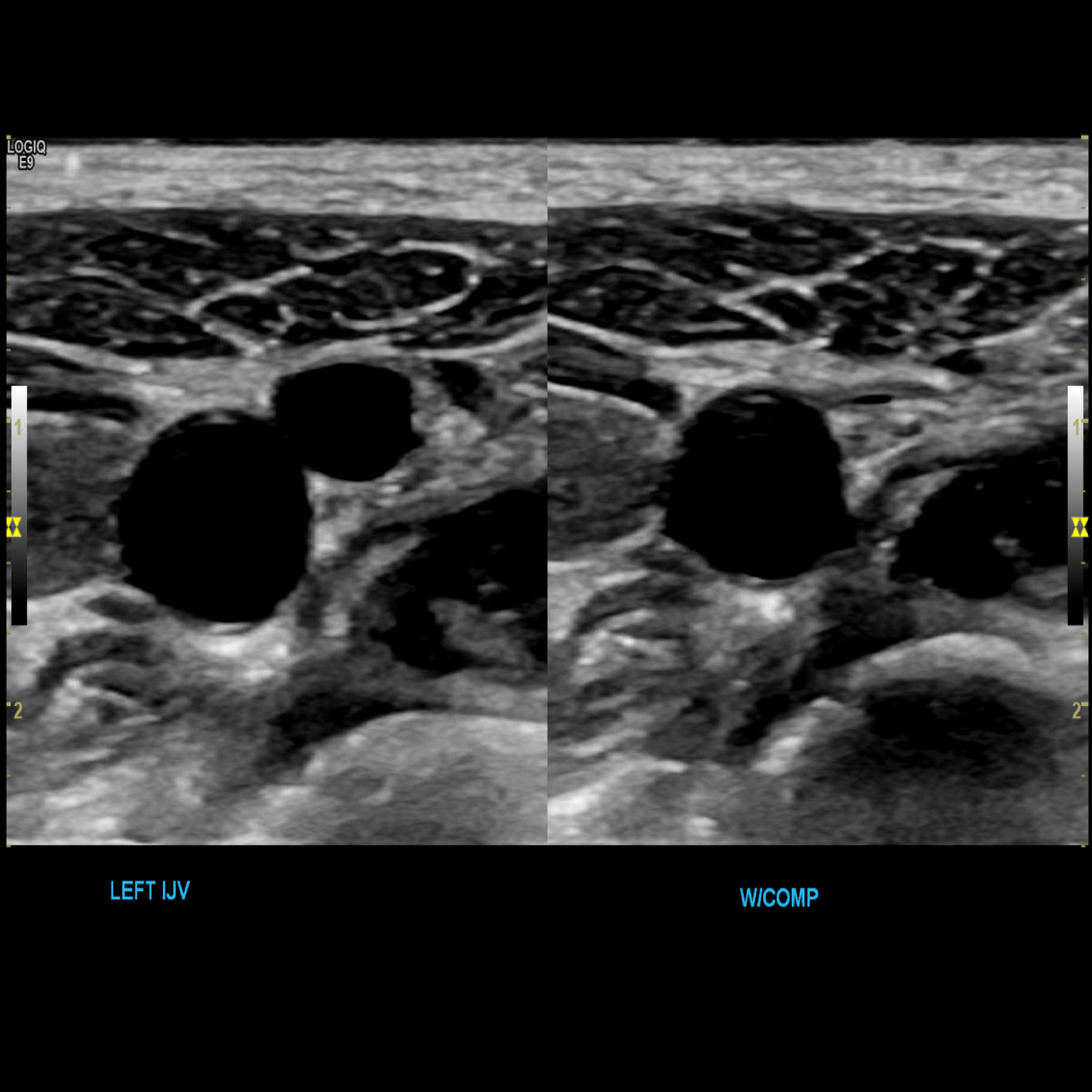 Upper Extremity Venous Doppler – Sonographic Tendencies
