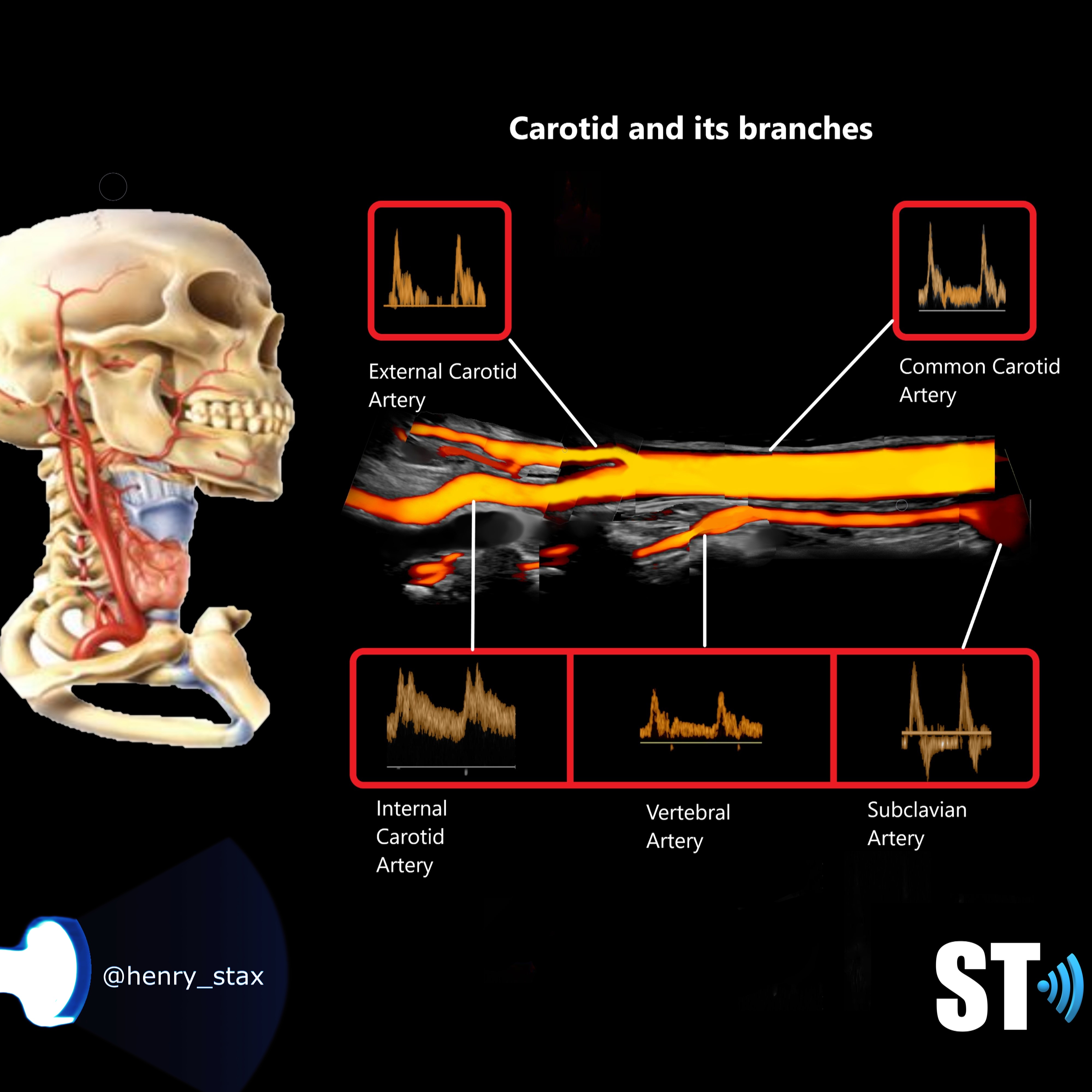 Carotid Duplex – Sonographic Tendencies