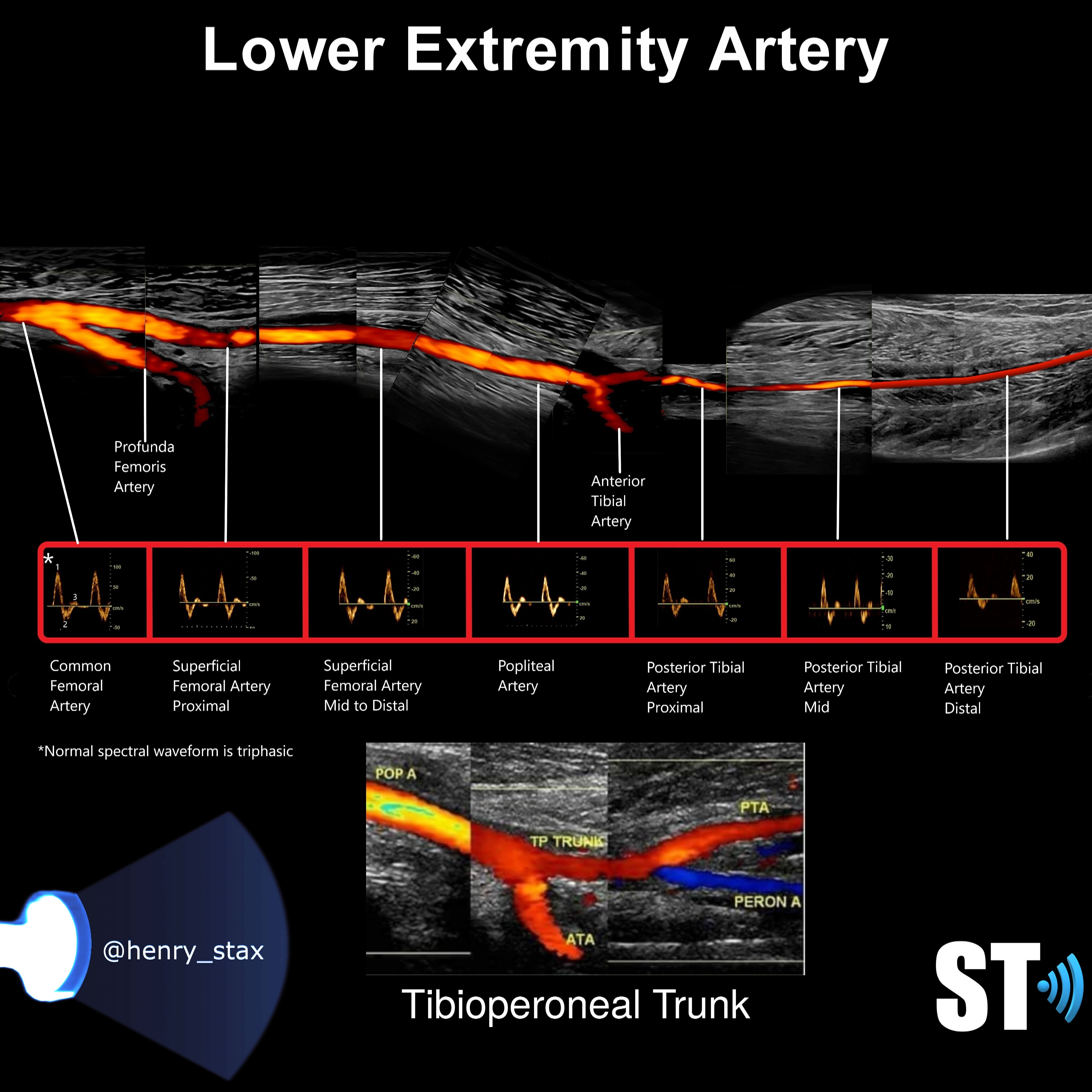 Arterial Doppler/Duplex of the Lower Extremities – Sonographic Tendencies
