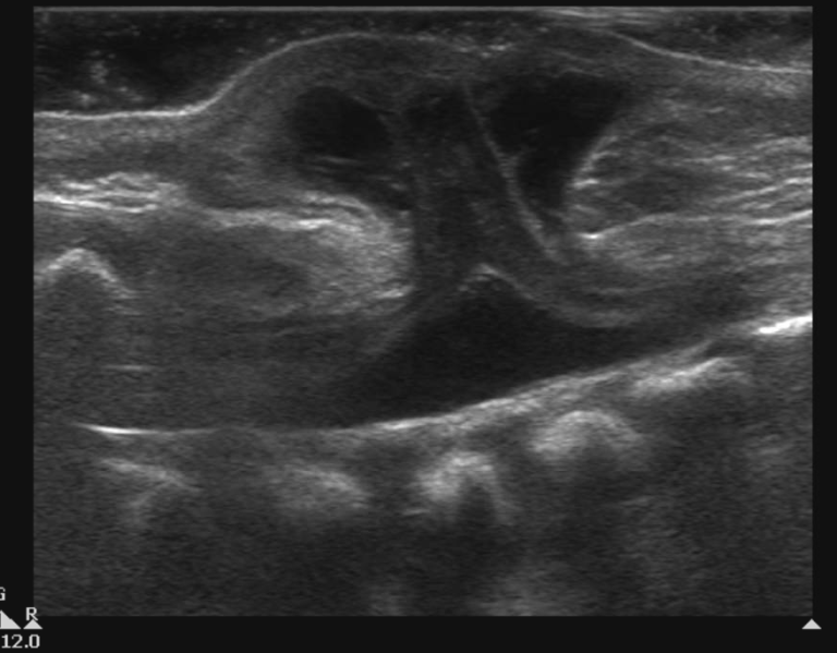 Neonatal/Infant Spine – Sonographic Tendencies