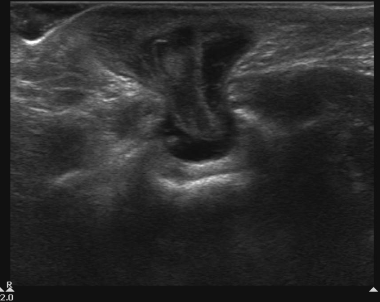 Neonatal/Infant Spine – Sonographic Tendencies