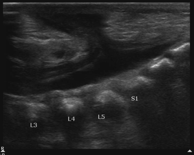 Neonatal/Infant Spine – Sonographic Tendencies