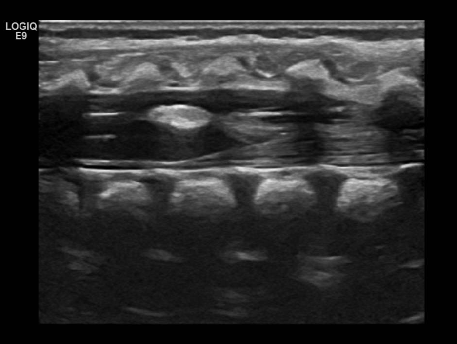 Neonatal/Infant Spine – Sonographic Tendencies