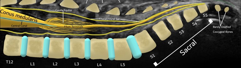 Neonatal/Infant Spine – Sonographic Tendencies