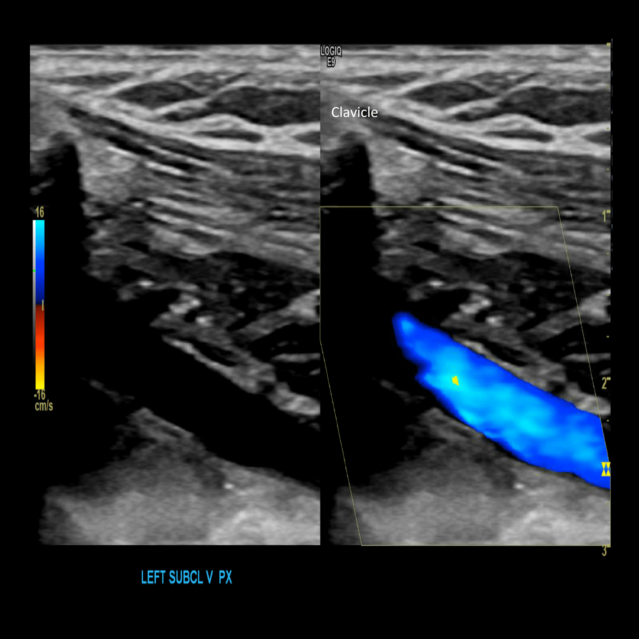 Upper Extremity Venous Doppler – Sonographic Tendencies