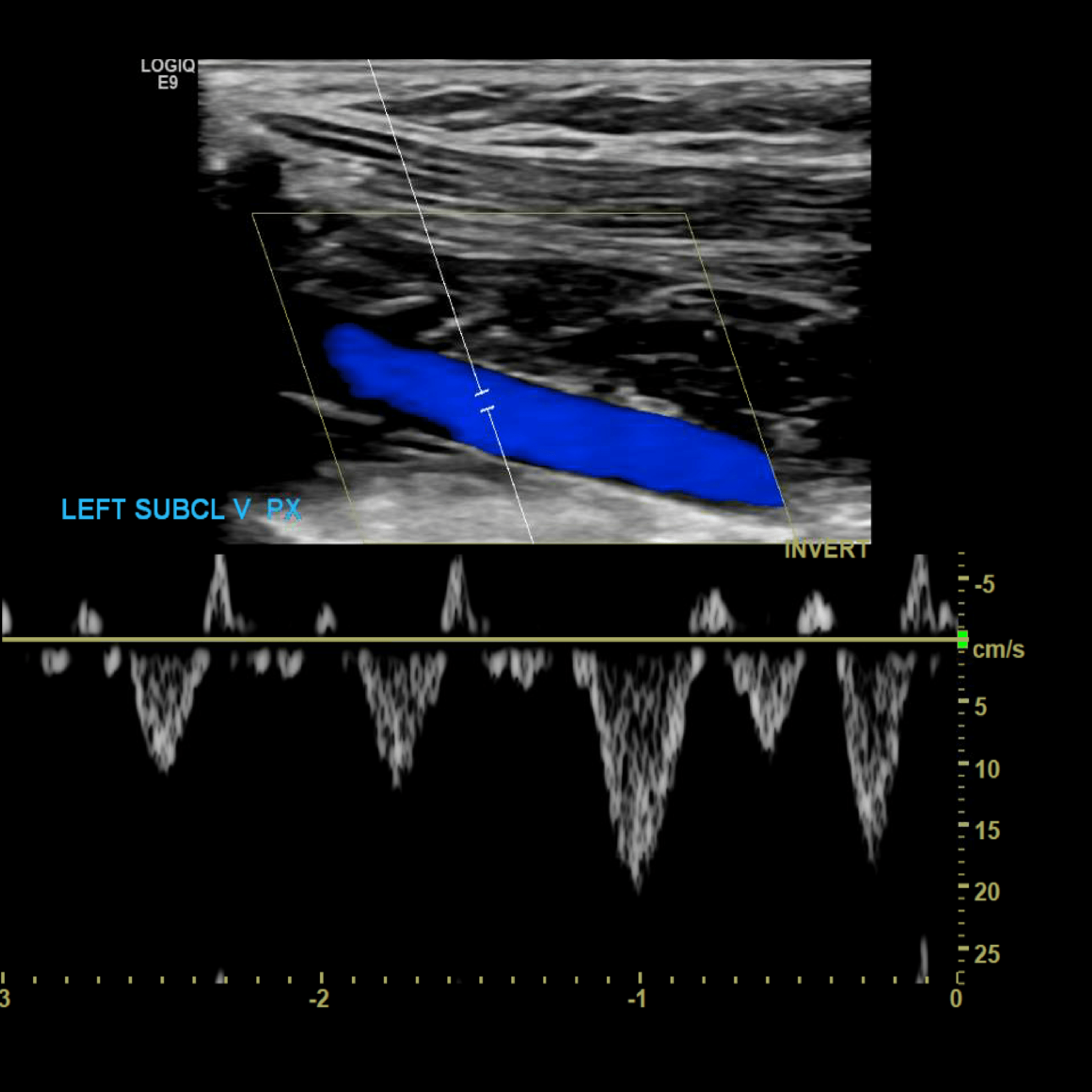 Upper Extremity Venous Doppler – Sonographic Tendencies