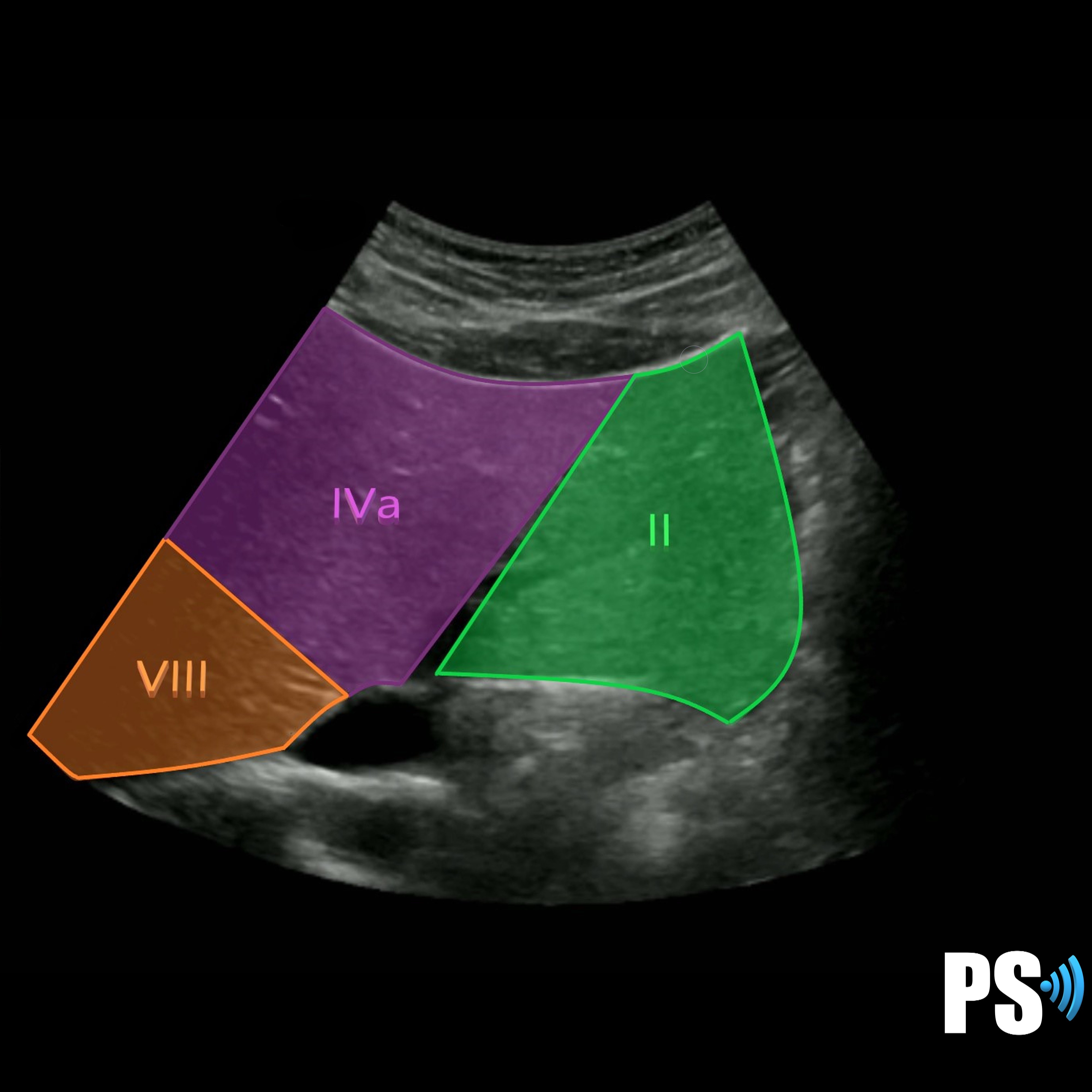Couinaud’s Liver Segments – Sonographic Tendencies