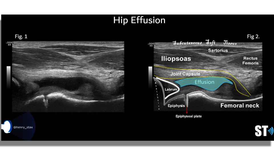 Hip Effusion – Sonographic Tendencies