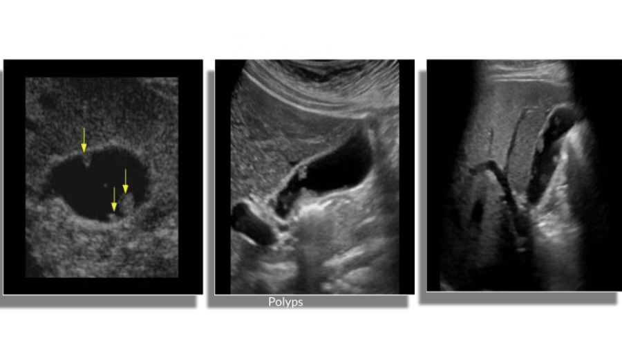 Gallbladder and Biliary Pathology – Sonographic Tendencies
