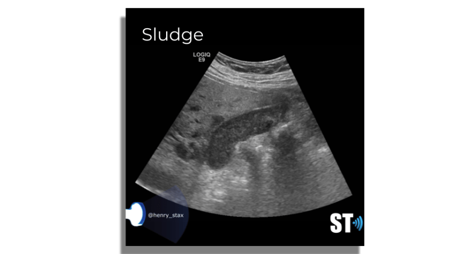 Gallbladder Sludge – Sonographic Tendencies