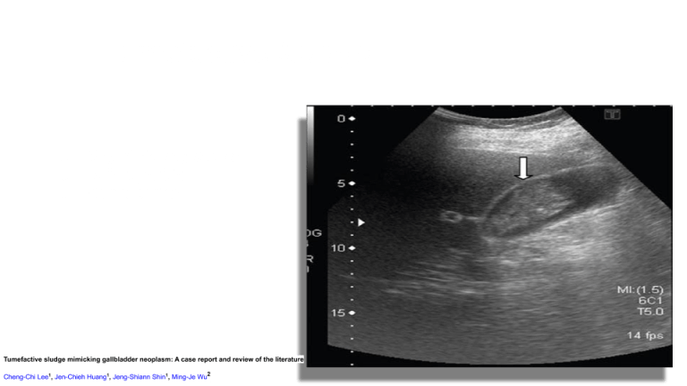 Gallbladder Sludge – Sonographic Tendencies