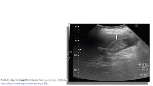 Gallbladder Sludge – Sonographic Tendencies