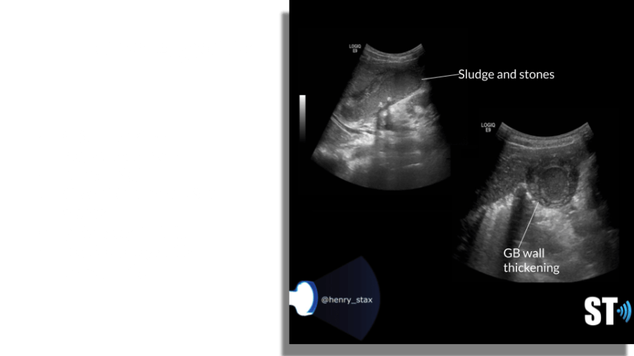 Gallbladder and Biliary Pathology – Sonographic Tendencies