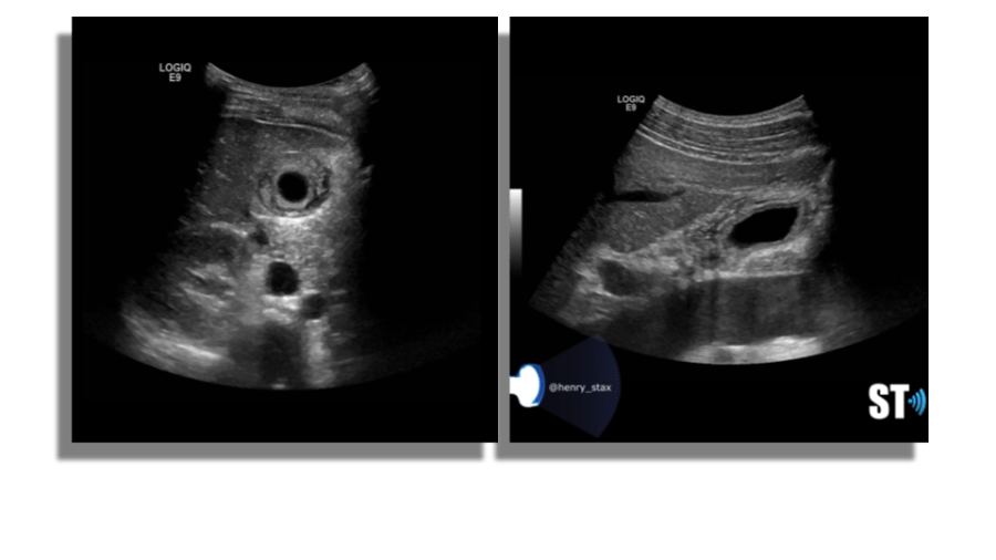 Gallbladder and Biliary Pathology – Sonographic Tendencies