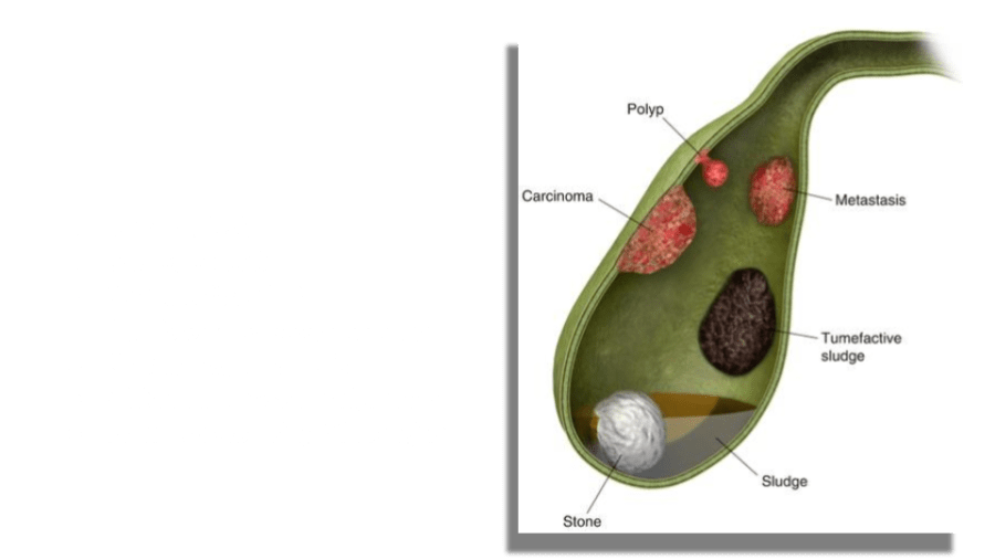 Gallbladder and Biliary Pathology – Sonographic Tendencies