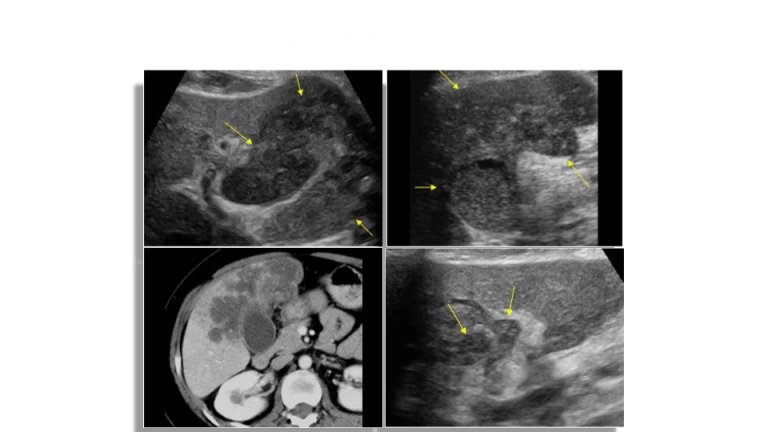 Gallbladder and Biliary Pathology – Sonographic Tendencies