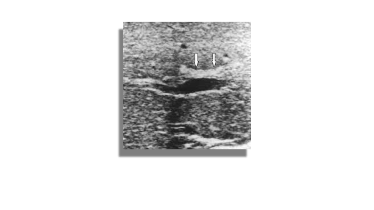 Gallbladder and Biliary Pathology – Sonographic Tendencies