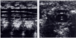 Neonatal/Infant Spine – Sonographic Tendencies