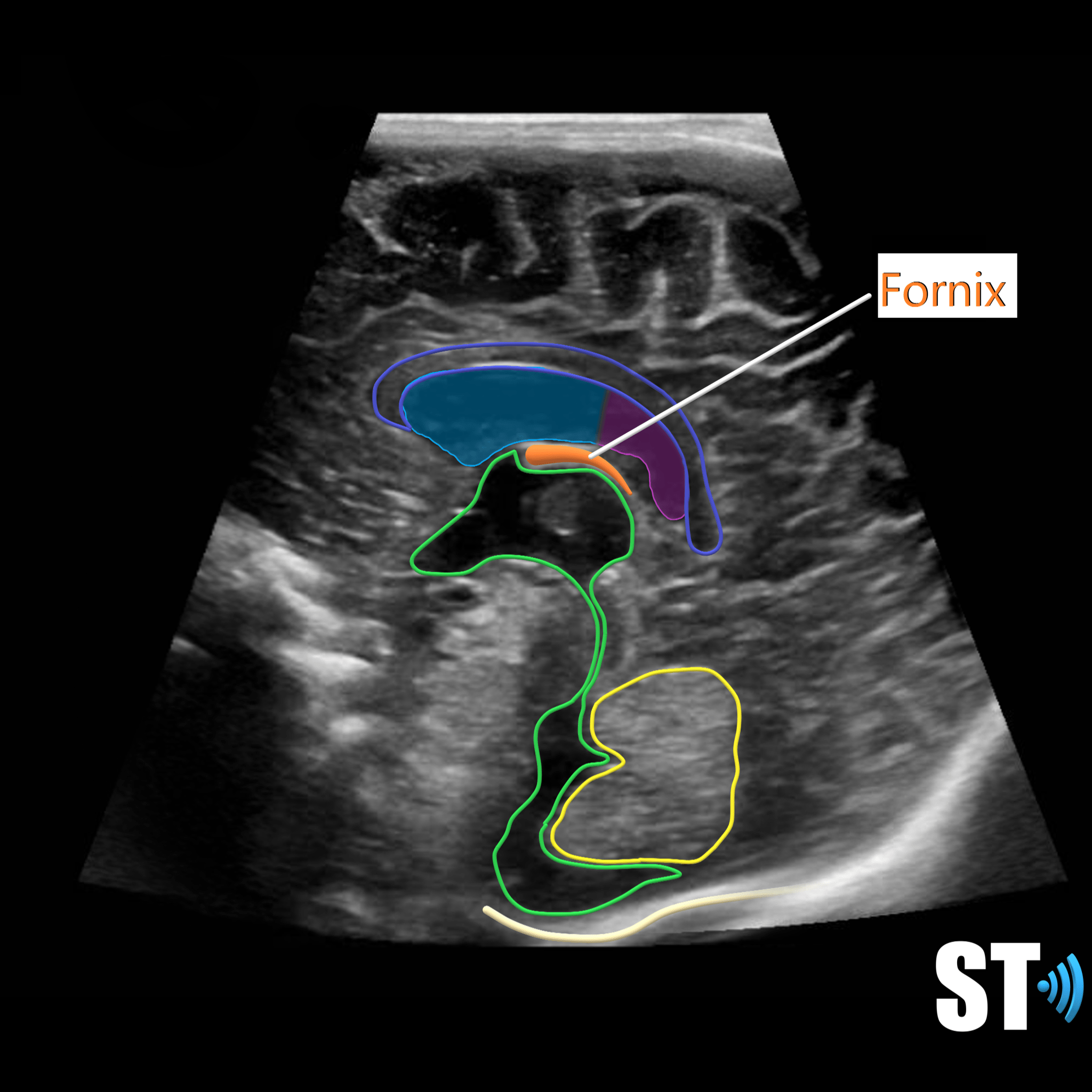 Neonatal Neurosonography – Sonographic Tendencies