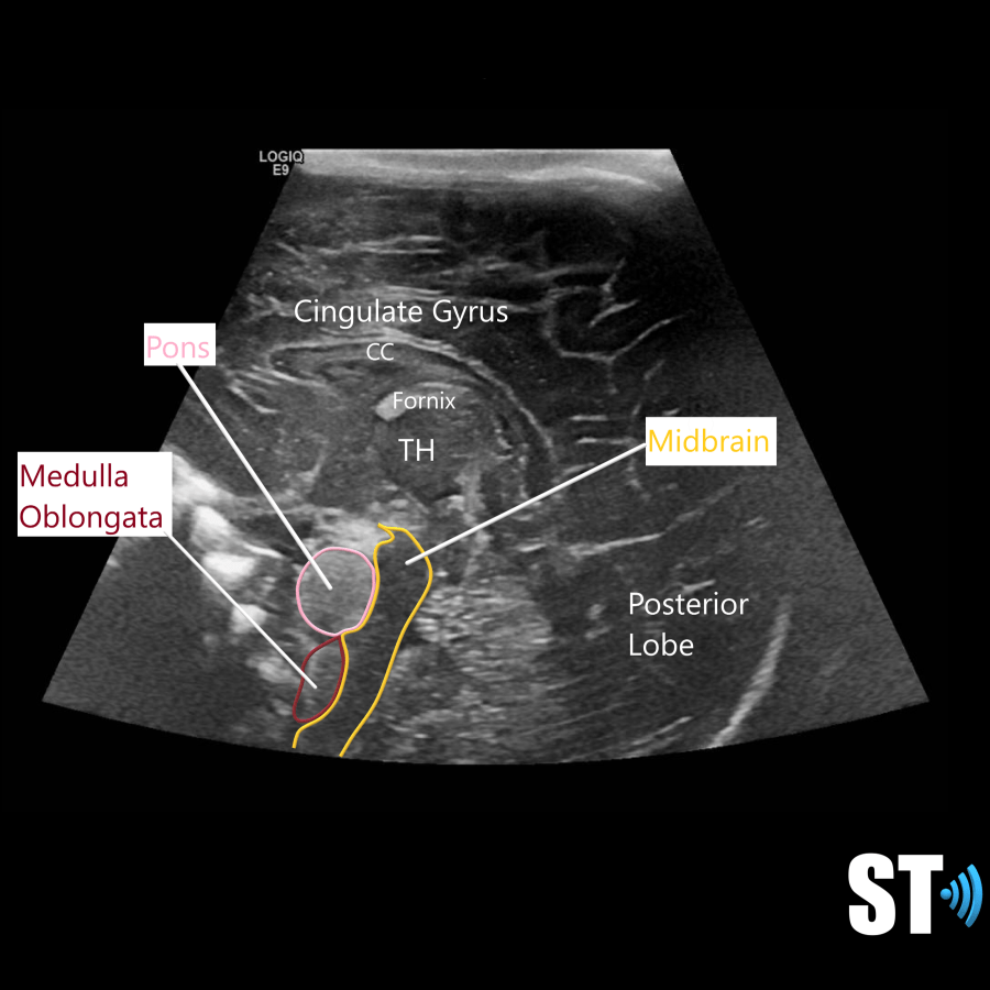 Neonatal Neurosonography – Sonographic Tendencies