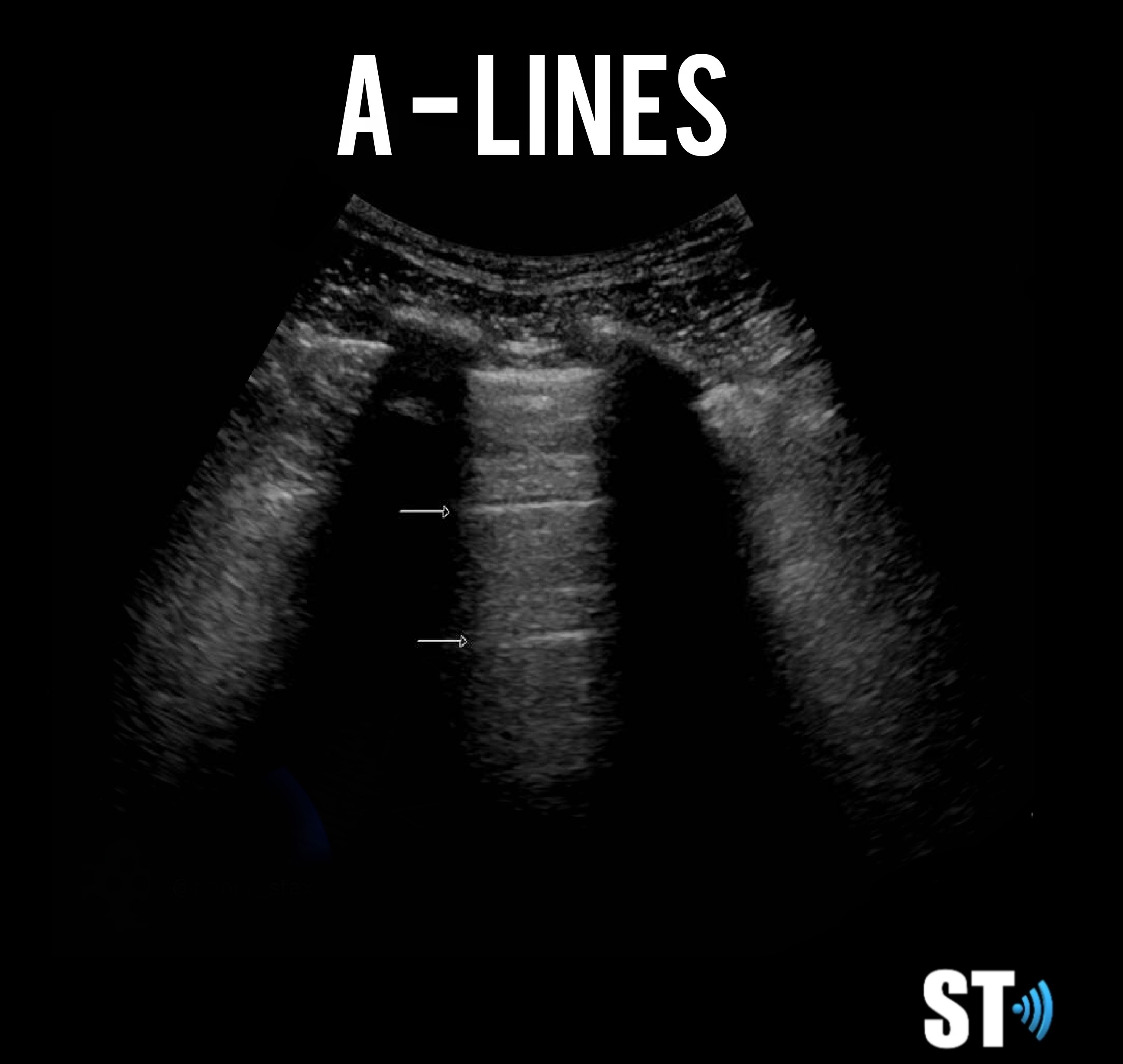 Chest and Lung Ultrasound – Sonographic Tendencies