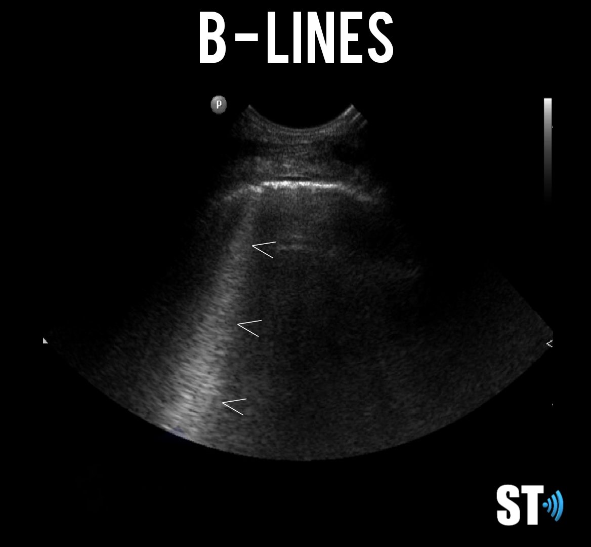 Chest and Lung Ultrasound – Sonographic Tendencies