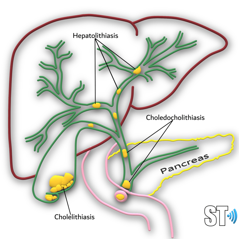 Gallbladder and Biliary Pathology – Sonographic Tendencies