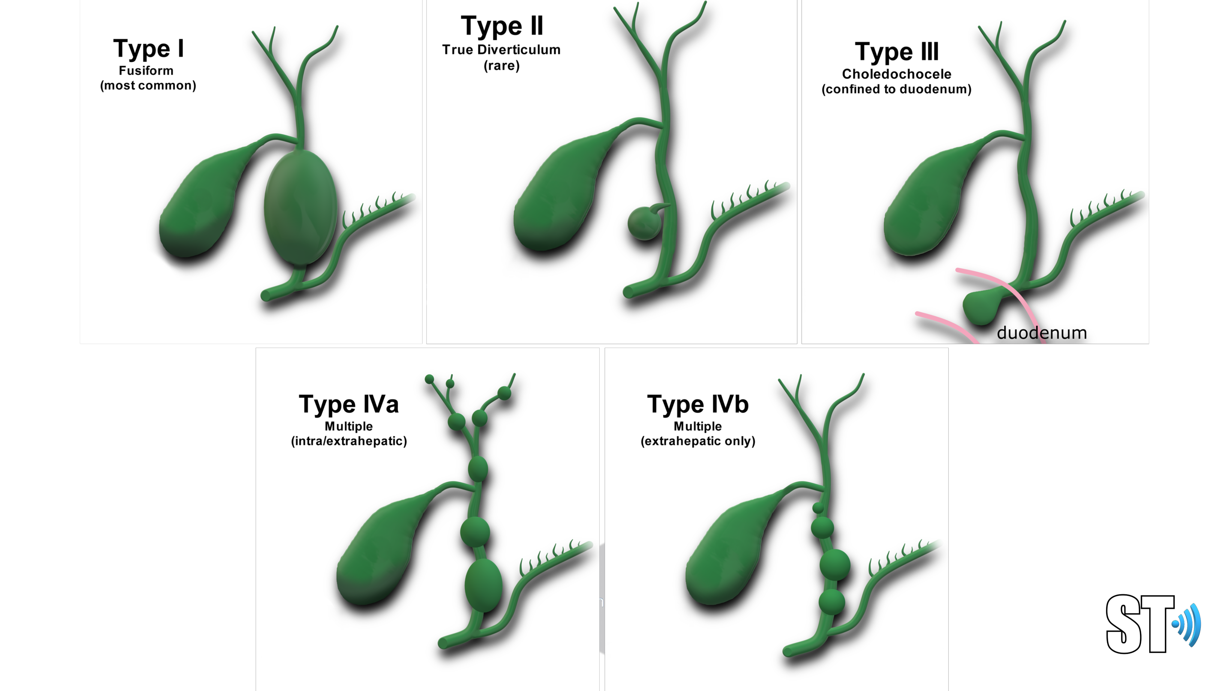 Gallbladder and Biliary Pathology – Sonographic Tendencies