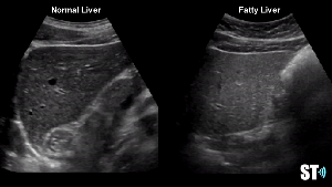 Hepatic Steatosis (Fatty Liver) – Sonographic Tendencies
