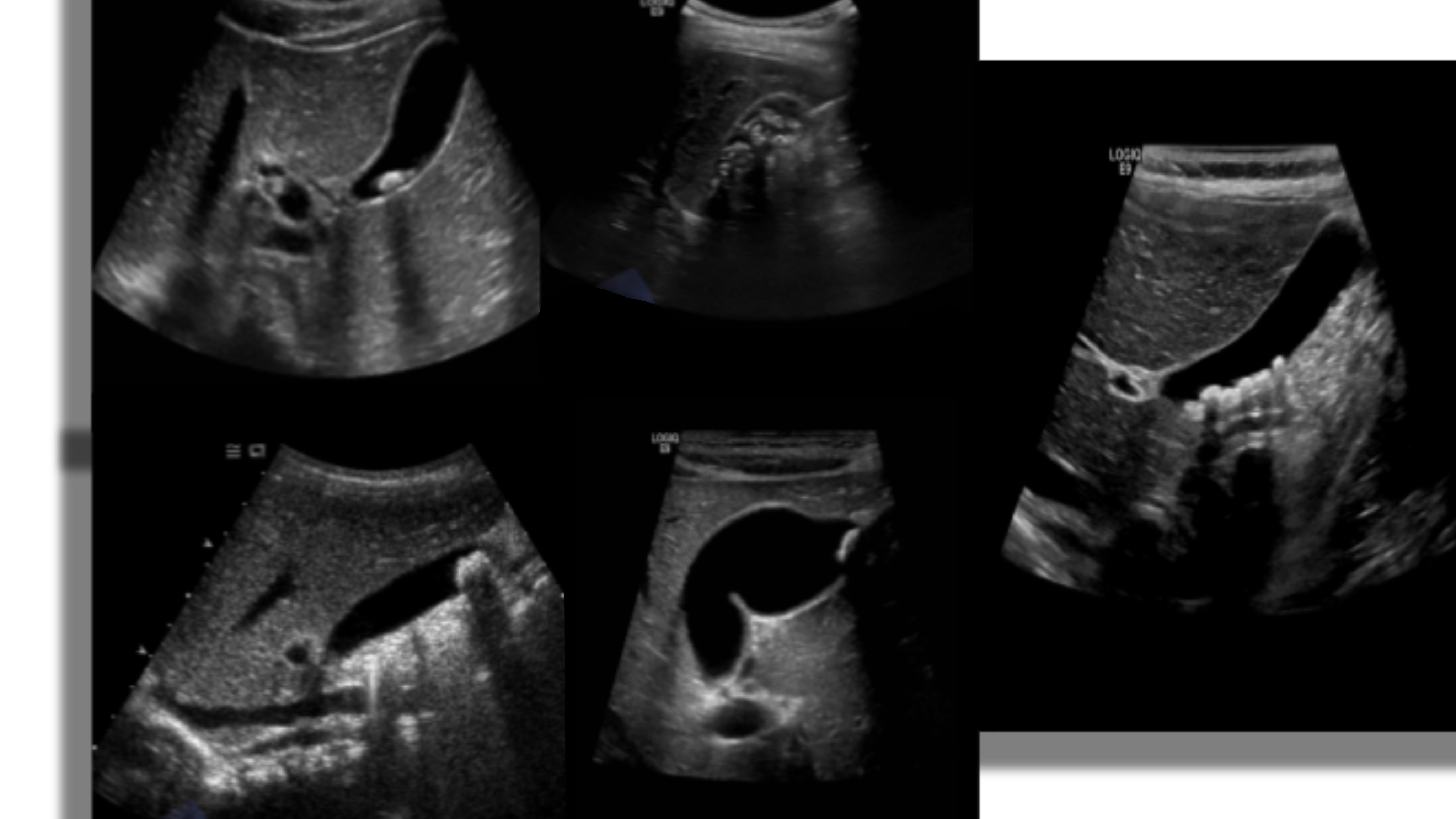 Gallbladder and Biliary Pathology – Sonographic Tendencies