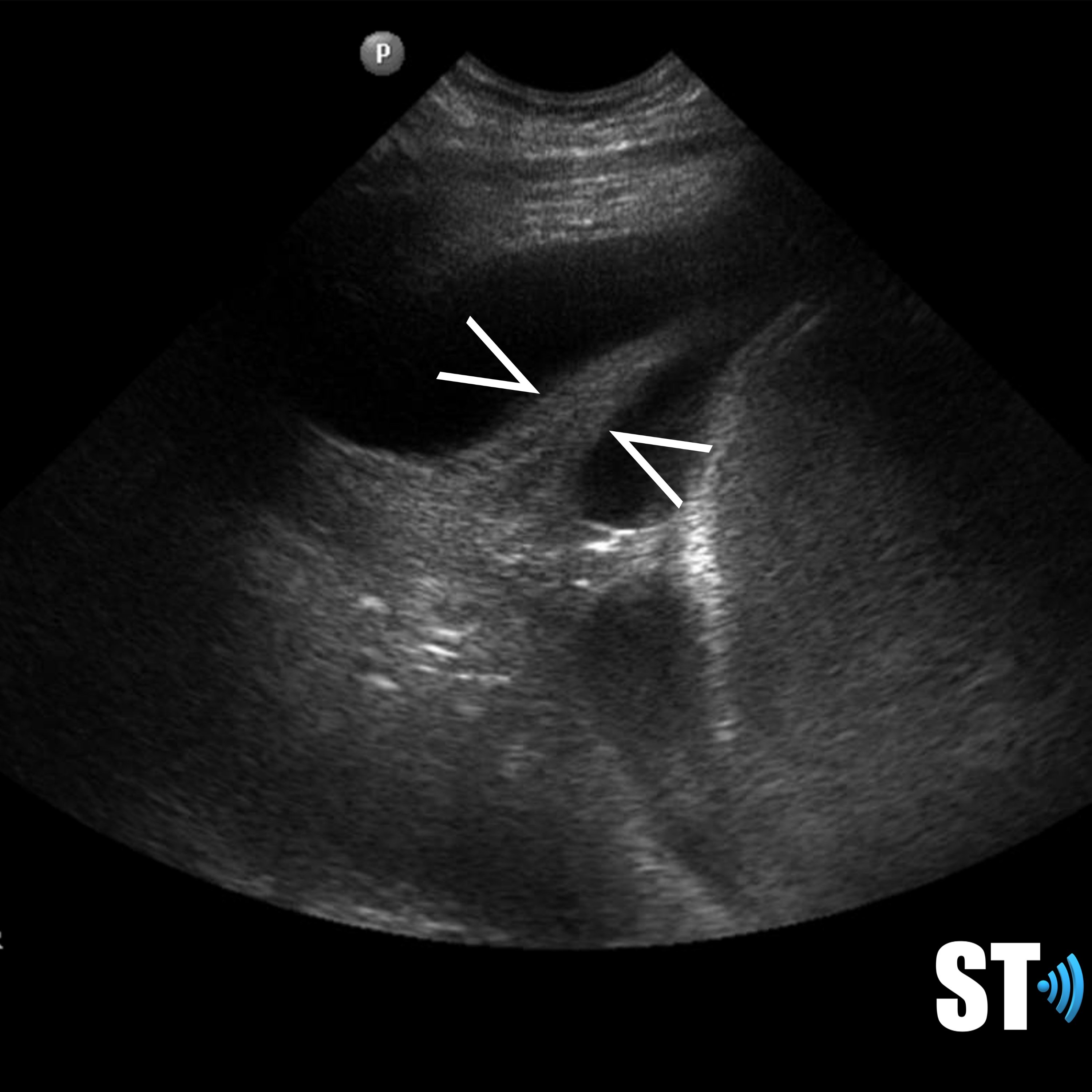 Chest and Lung Ultrasound – Sonographic Tendencies