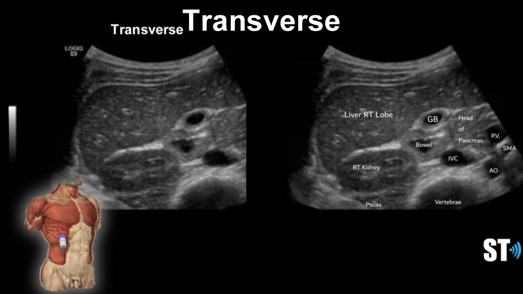 Liver Anatomy and Protocol – Sonographic Tendencies