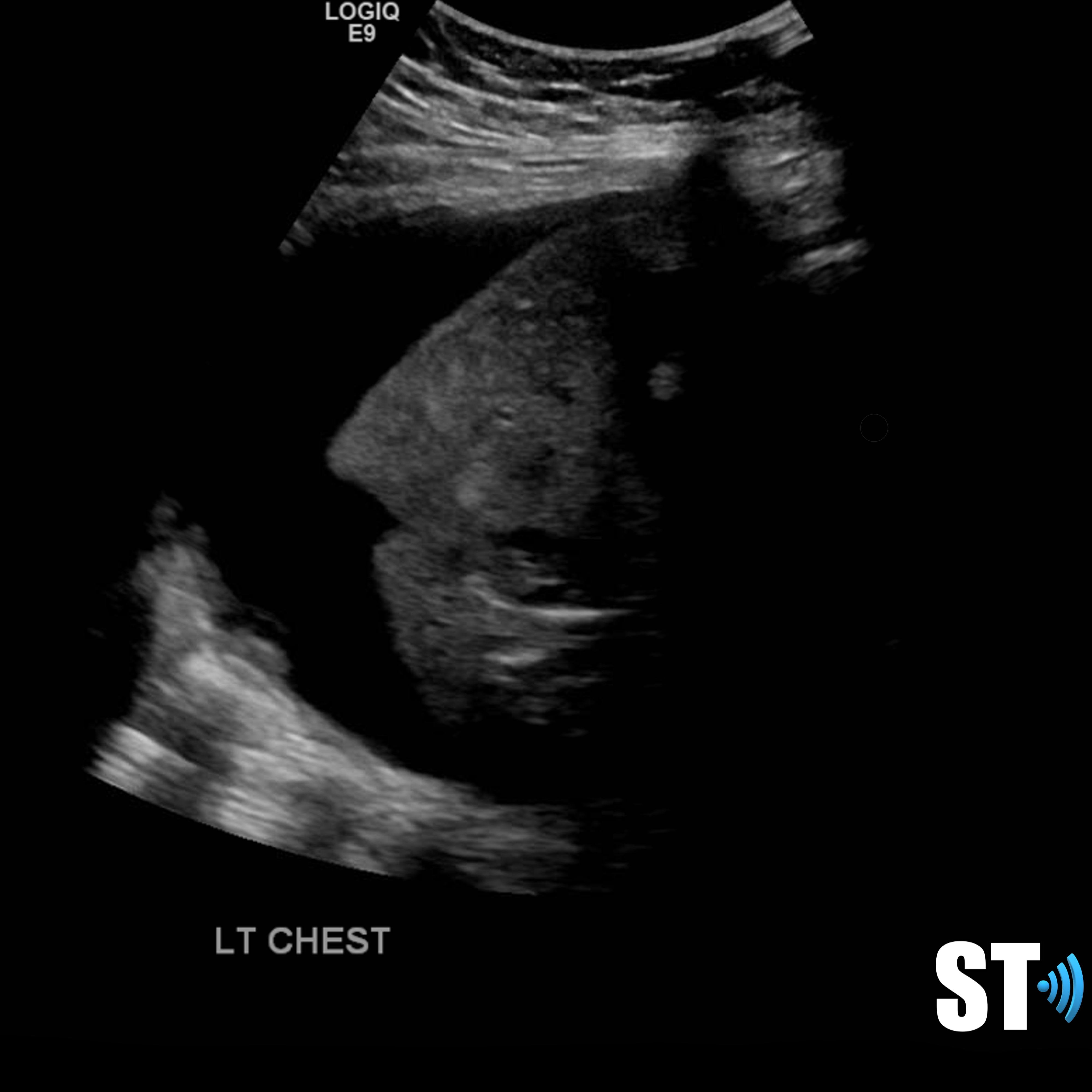 Chest and Lung Ultrasound – Sonographic Tendencies
